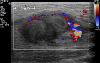 Testicular Torsion | UAMS Department of Radiology