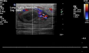 Testicular Torsion | UAMS Department of Radiology