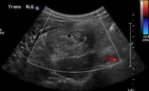 Intussusception | UAMS Department of Radiology
