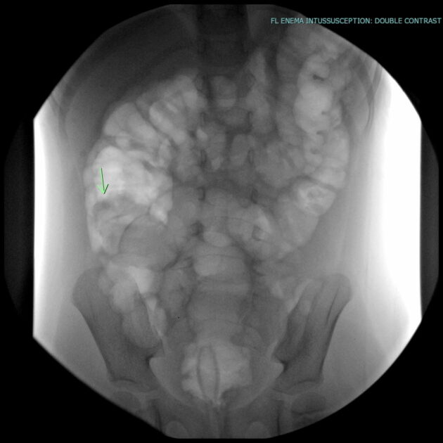 Intussusception UAMS Department Of Radiology Intussusception UAMS Department Of Radiology