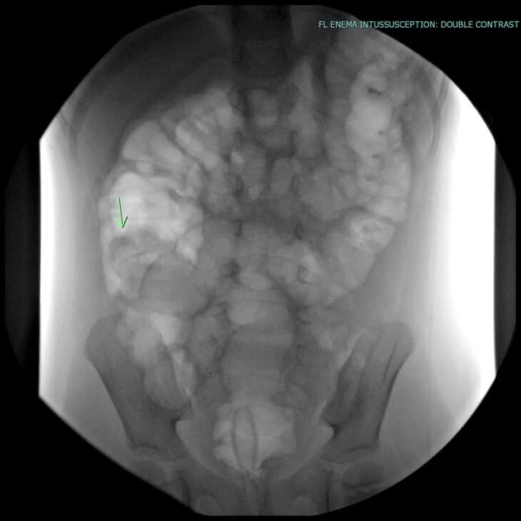 Intussusception | UAMS Department of Radiology