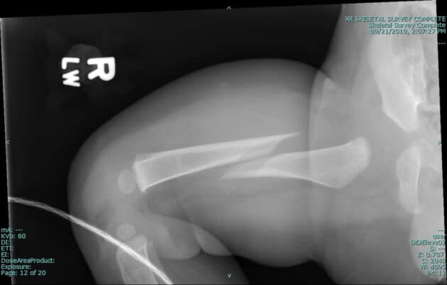 Nonaccidental Trauma | UAMS Department of Radiology