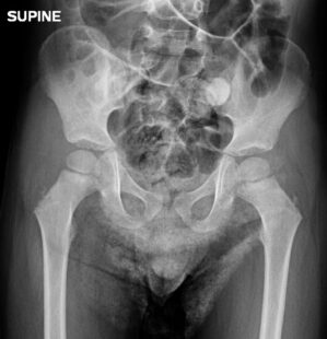 Irritable Hip | UAMS Department of Radiology