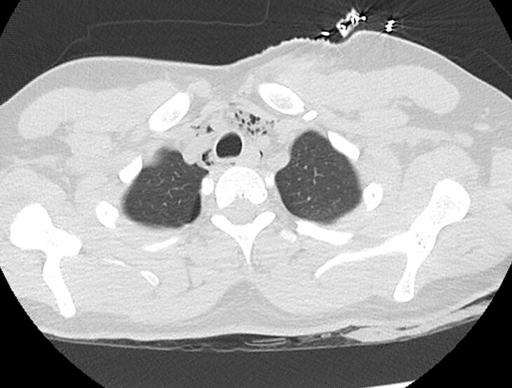 Pneumothorax, Pneumomediastinum – Air Leaks In The ICU | UAMS ...