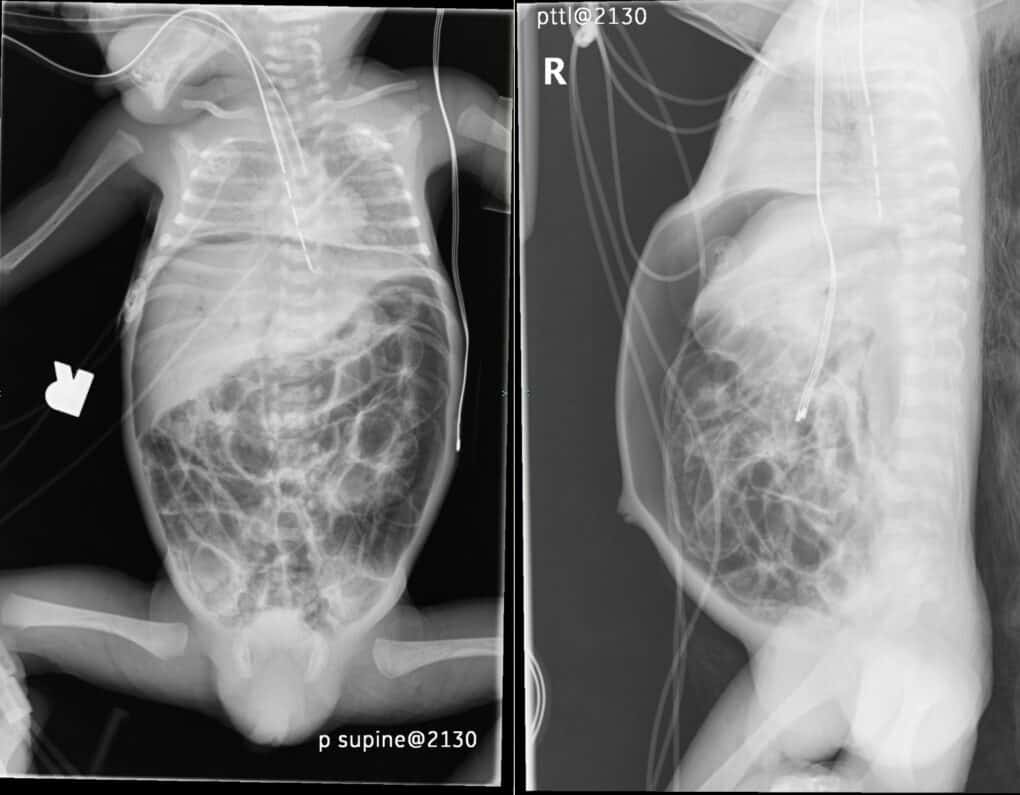 Pneumothorax, Pneumomediastinum – Air Leaks In The ICU | UAMS ...