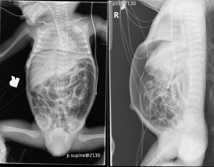 Pneumothorax, Pneumomediastinum – Air Leaks In The ICU | UAMS ...