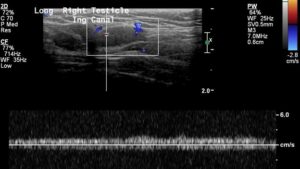 Testicular Torsion | UAMS Department of Radiology