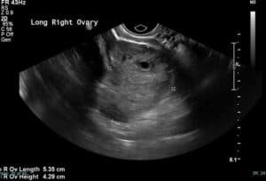 Ovarian Torsion | UAMS Department of Radiology