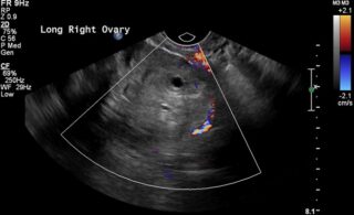 Ovarian Torsion | UAMS Department of Radiology