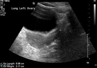 Ovarian Torsion | UAMS Department of Radiology