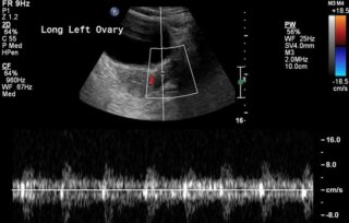 Ovarian Torsion | UAMS Department of Radiology